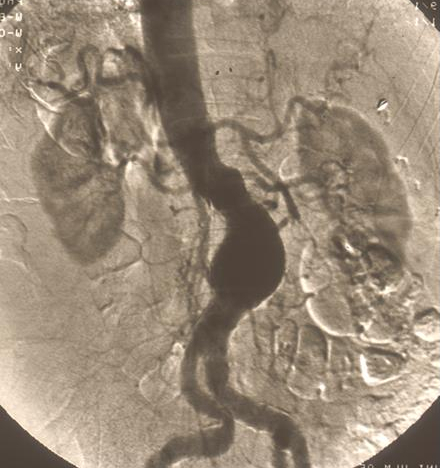 Aneurysmen der abdominellen und thorakalen Aorta | Klinikum Esslingen